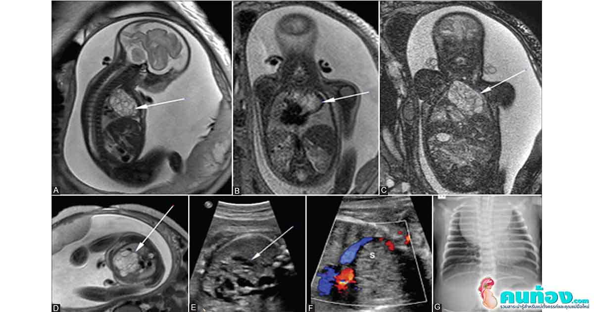 แอบดูทารกในครรภ์ ด้วยเครื่อง MRI พร้อมข้อดีของการใช้เครื่องนี้ ...